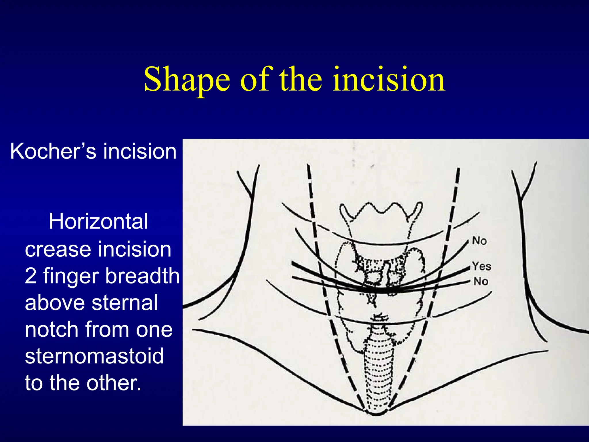 Detailed technique of Thyroidectomy .ppt