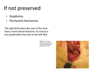 thyroidectomy notes.pptx