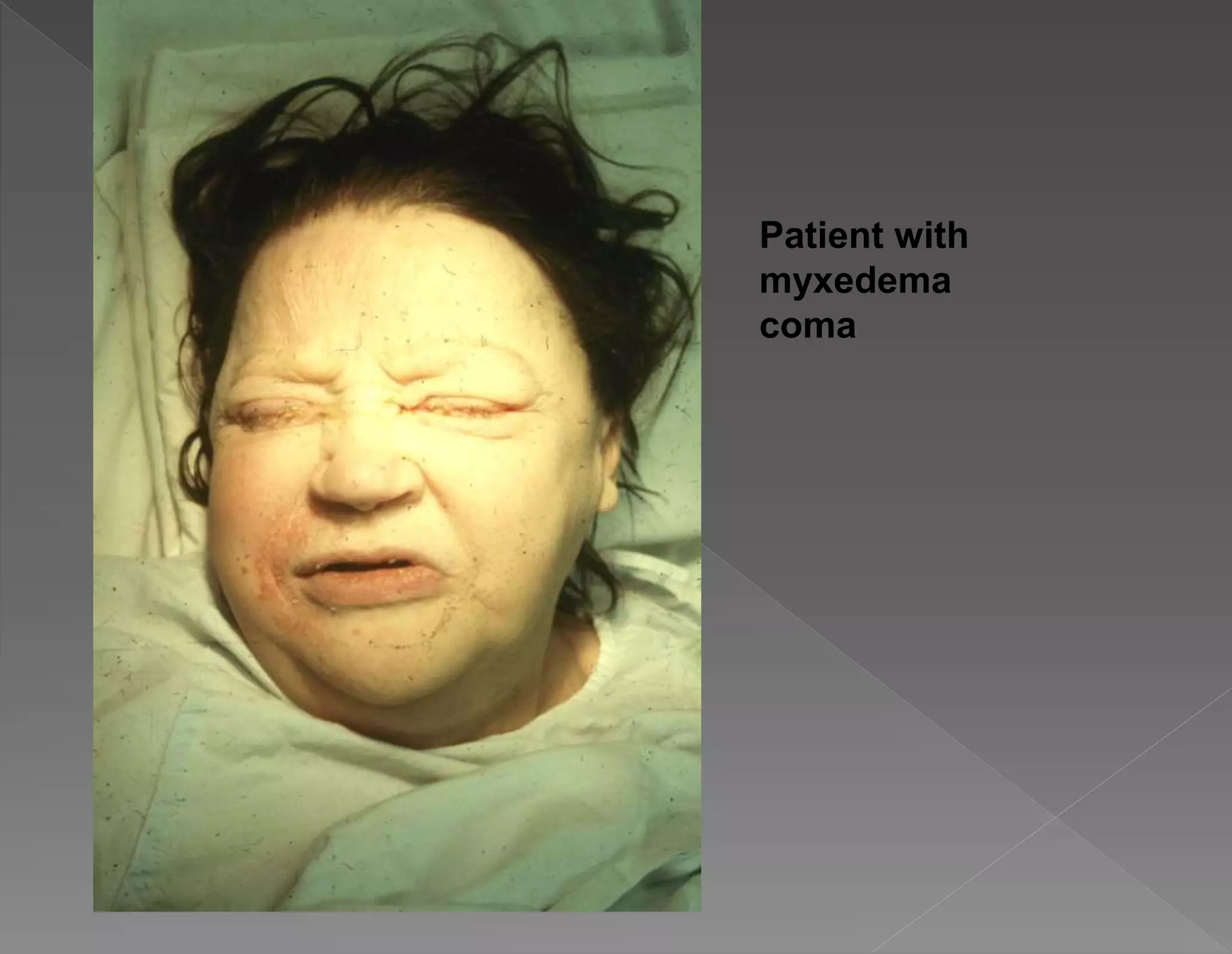 thyroid emergencies.ppt