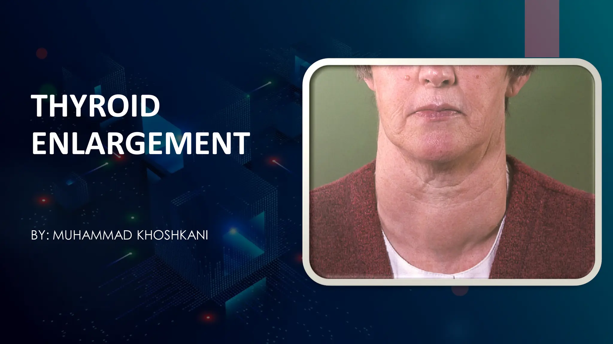 thyroid enlargment, goitre, including its types, causes, diagnosis ...