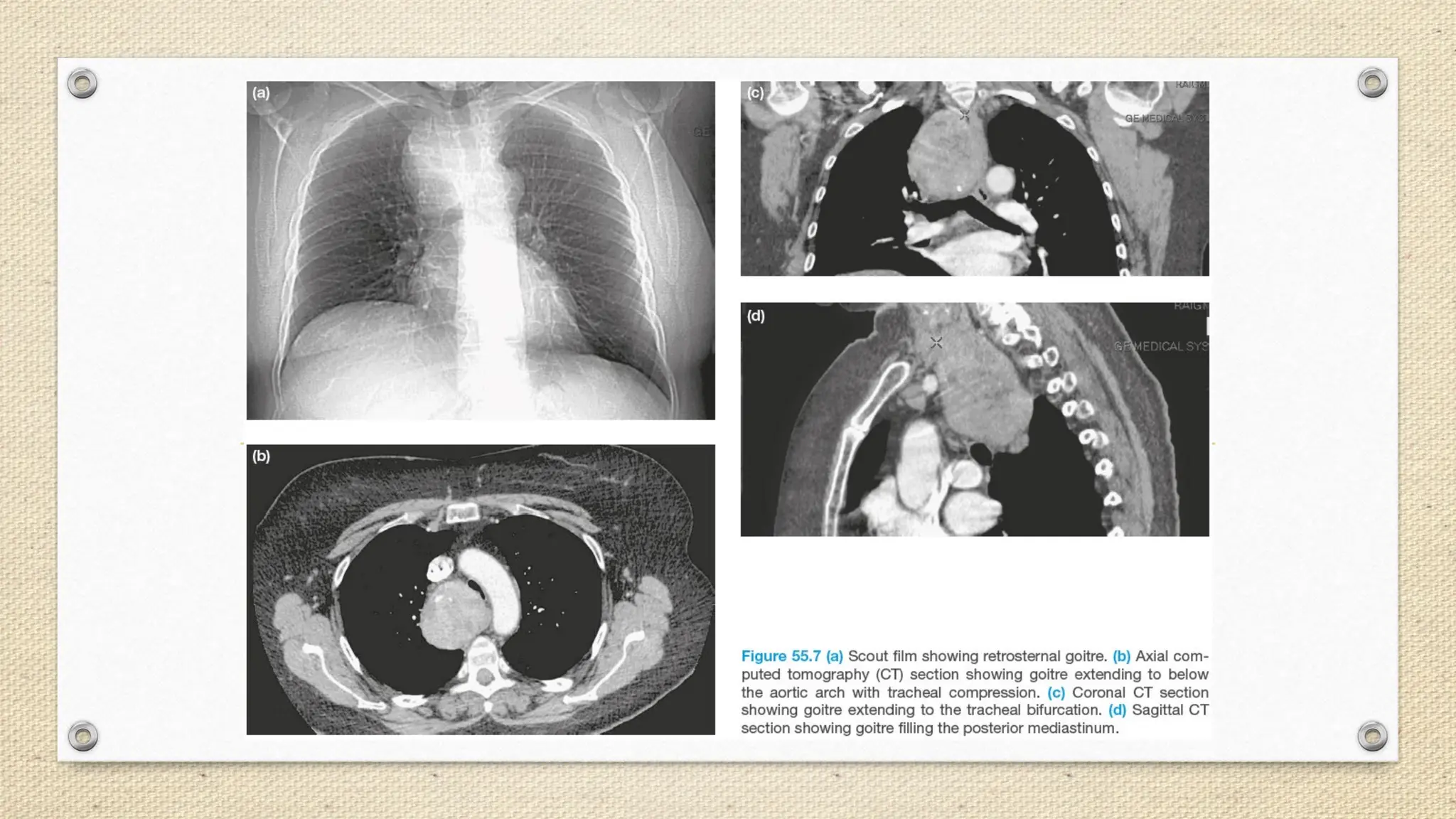thyroid enlargment, goitre, including its types, causes, diagnosis ...