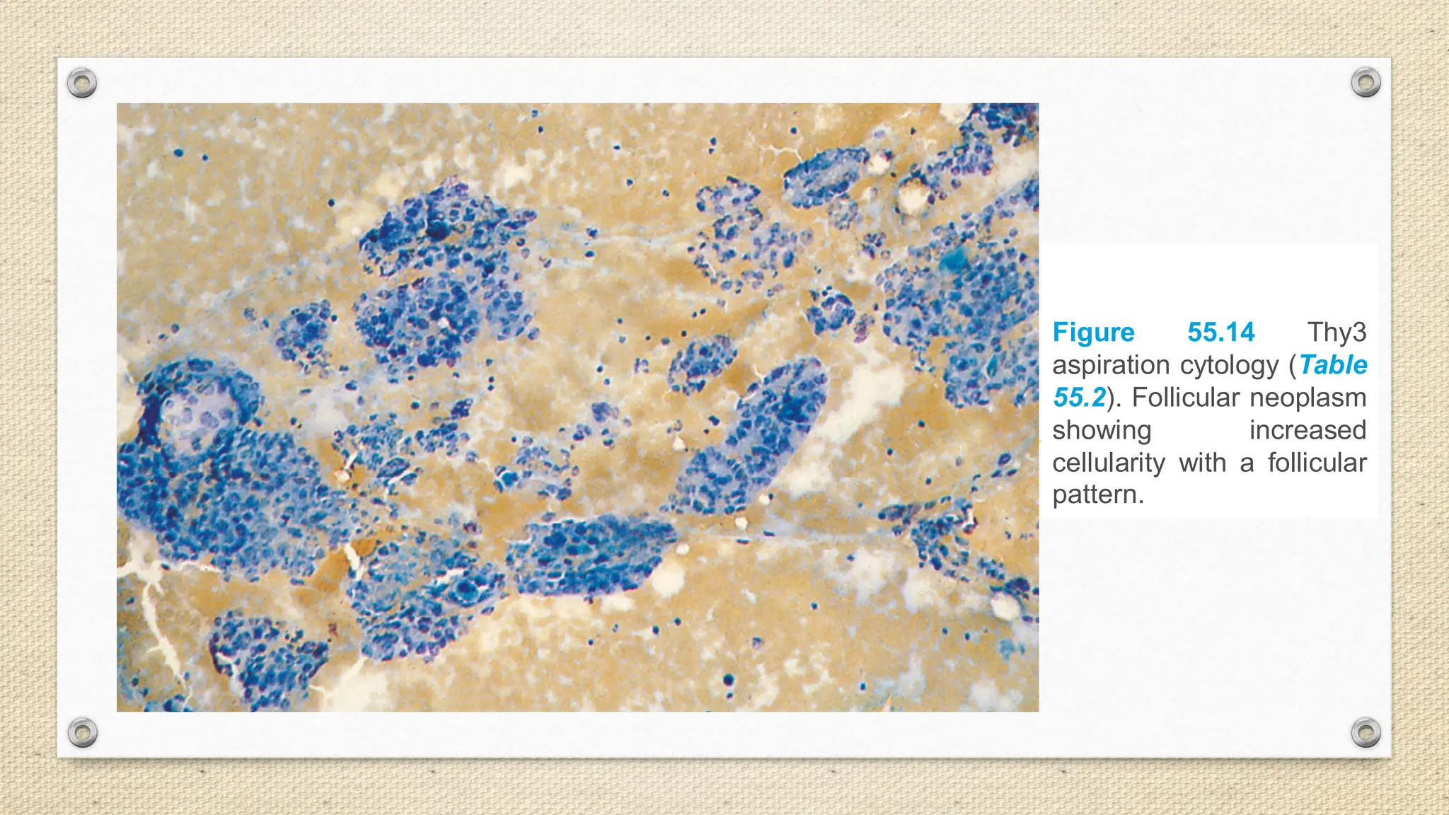 thyroid enlargment, goitre, including its types, causes, diagnosis ...