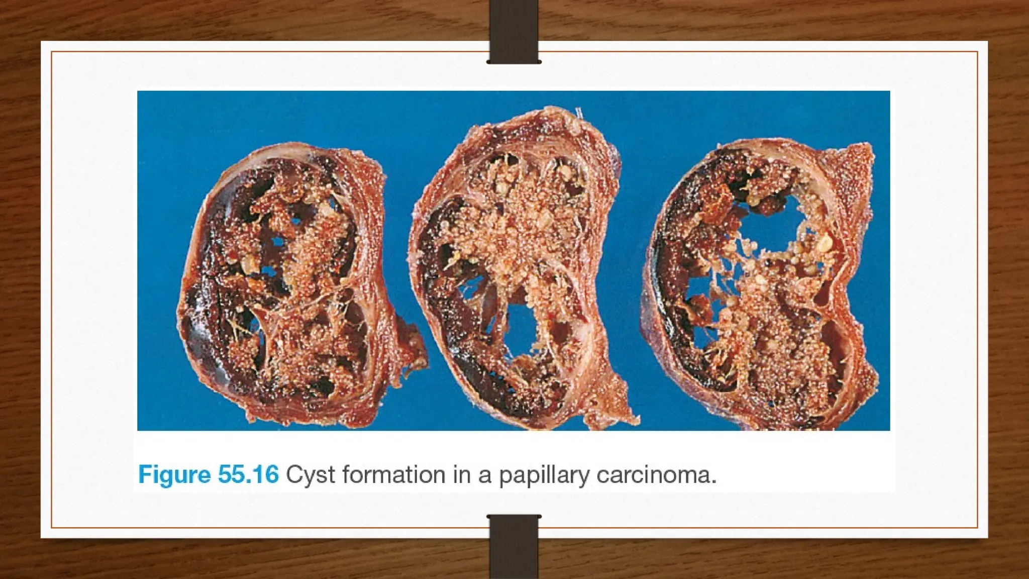 thyroid enlargment, goitre, including its types, causes, diagnosis ...