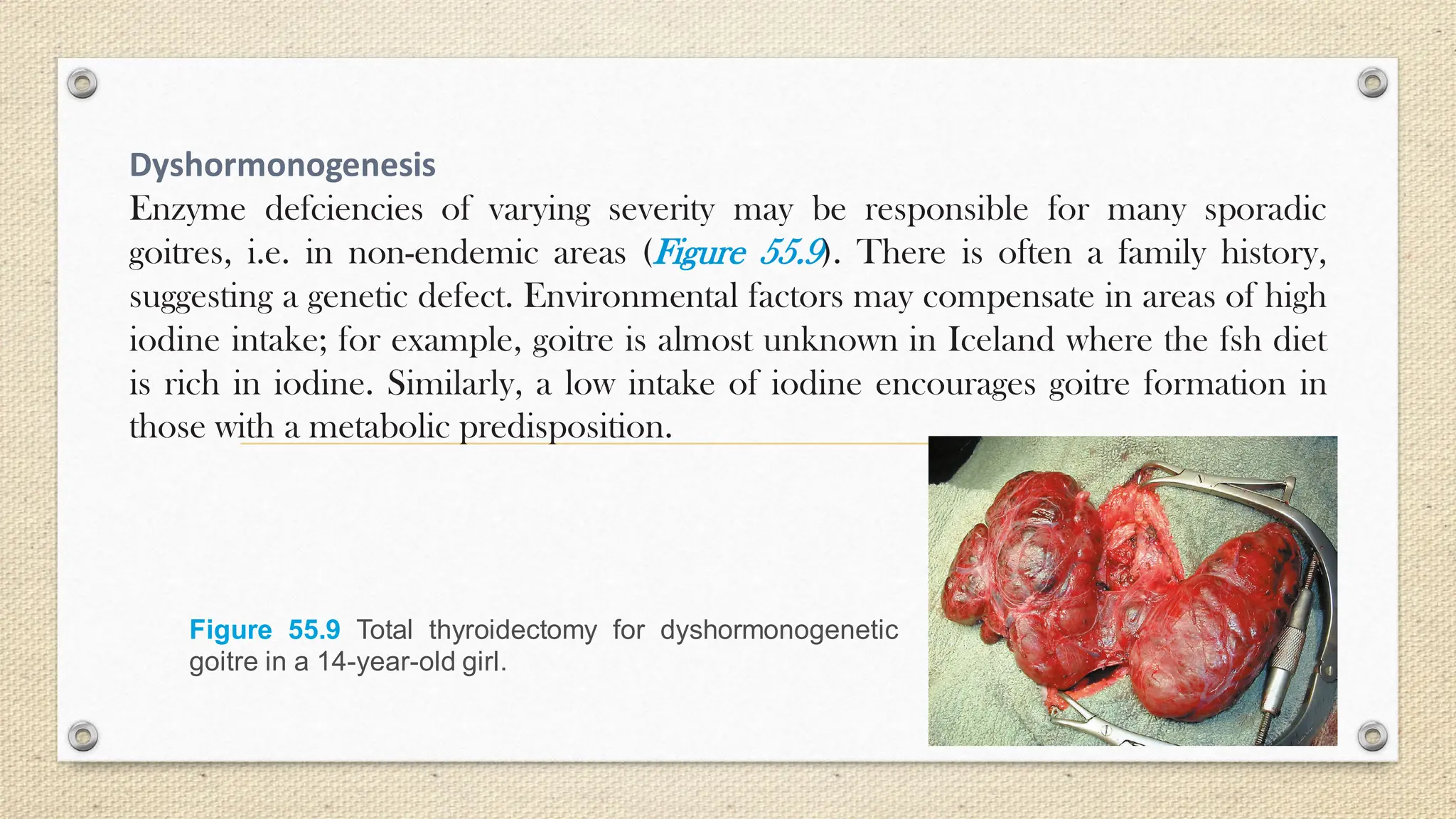 thyroid enlargment, goitre, including its types, causes, diagnosis ...