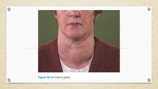 thyroid enlargment, goitre, including its types, causes, diagnosis ...