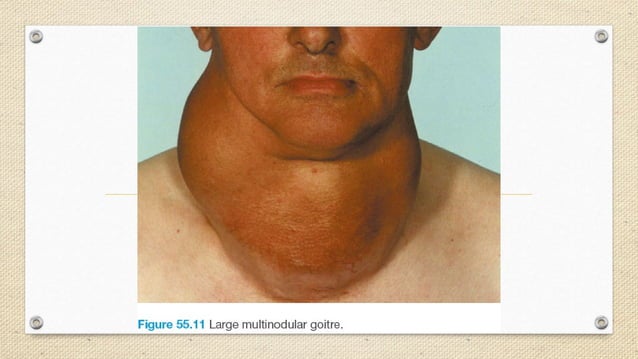 thyroid enlargment, goitre, including its types, causes, diagnosis ...