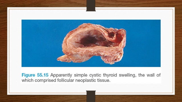 thyroid enlargment, goitre, including its types, causes, diagnosis ...