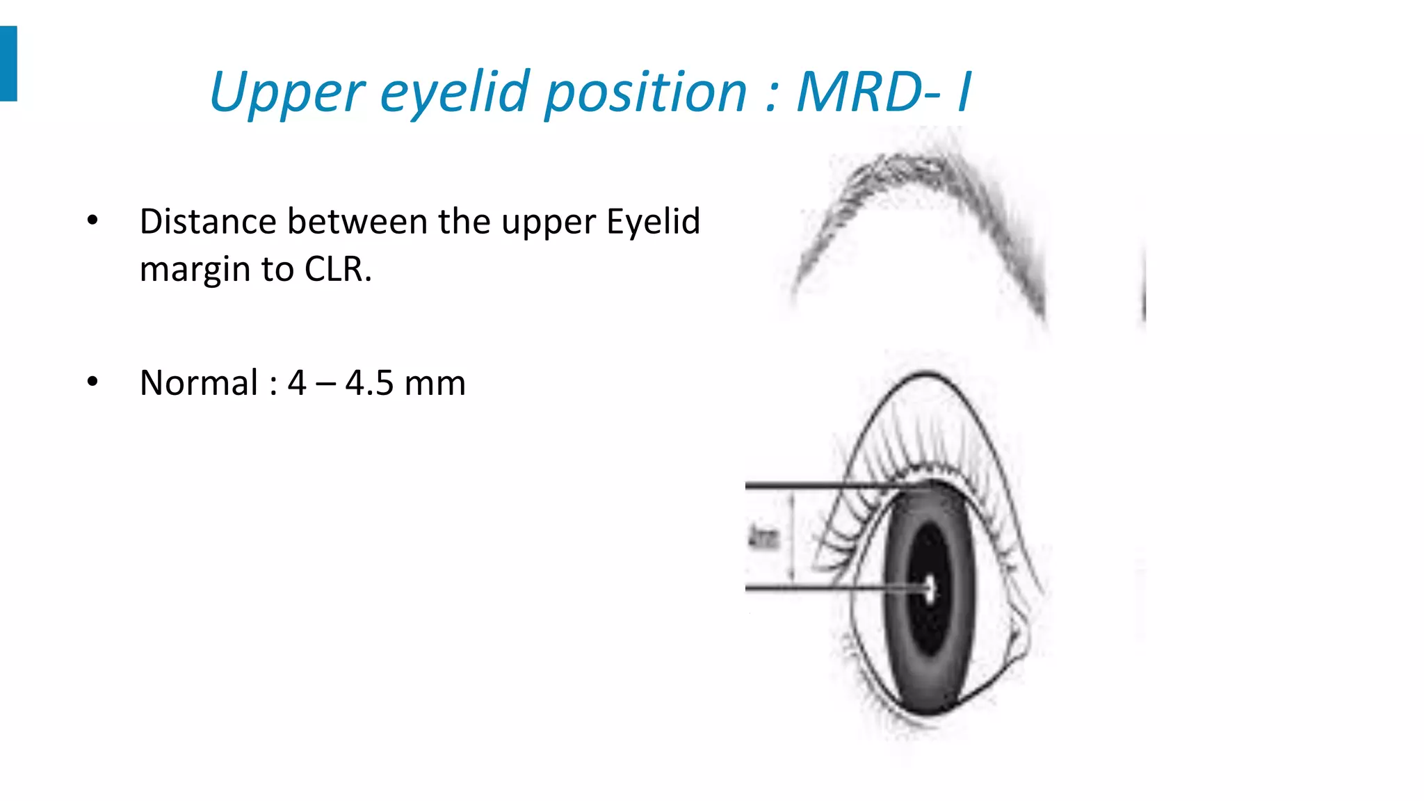 Thyroid eye disease evaluation and management | PPT