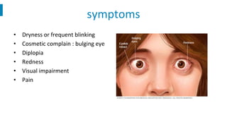 Thyroid eye disease evaluation and management | PPT
