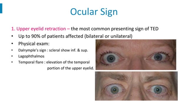 Thyroid eye disease evaluation and management | PPT | Thyroid Disorders ...