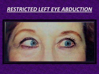 Thyroid eye disease | PPTX