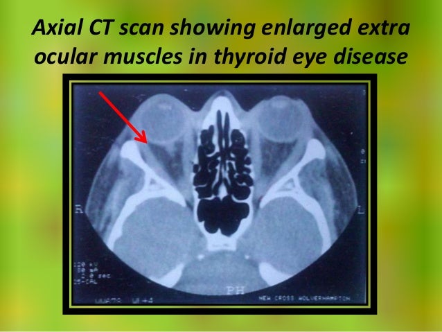 Thyroid eye disease