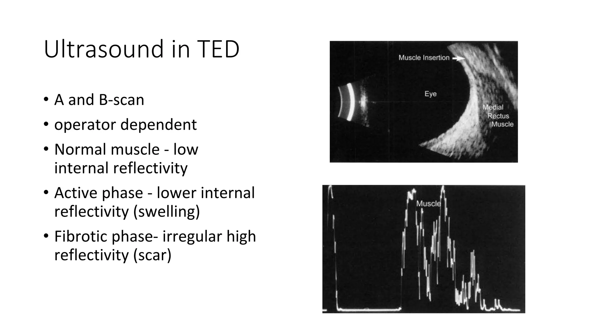 Thyroid eye disease ( Graves Ophthalmopathy ) | PPTX