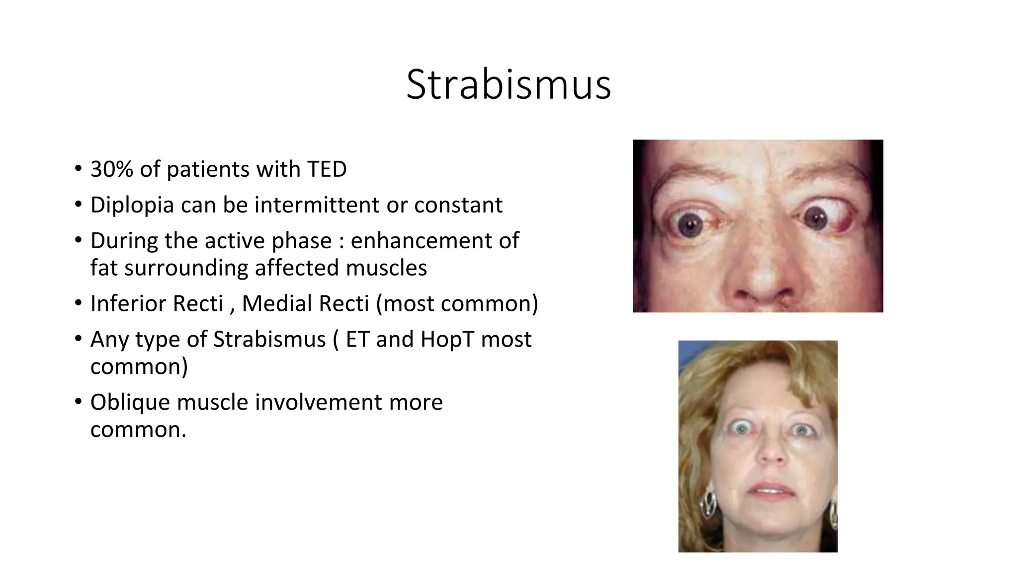 Thyroid eye disease ( Graves Ophthalmopathy ) | PPTX