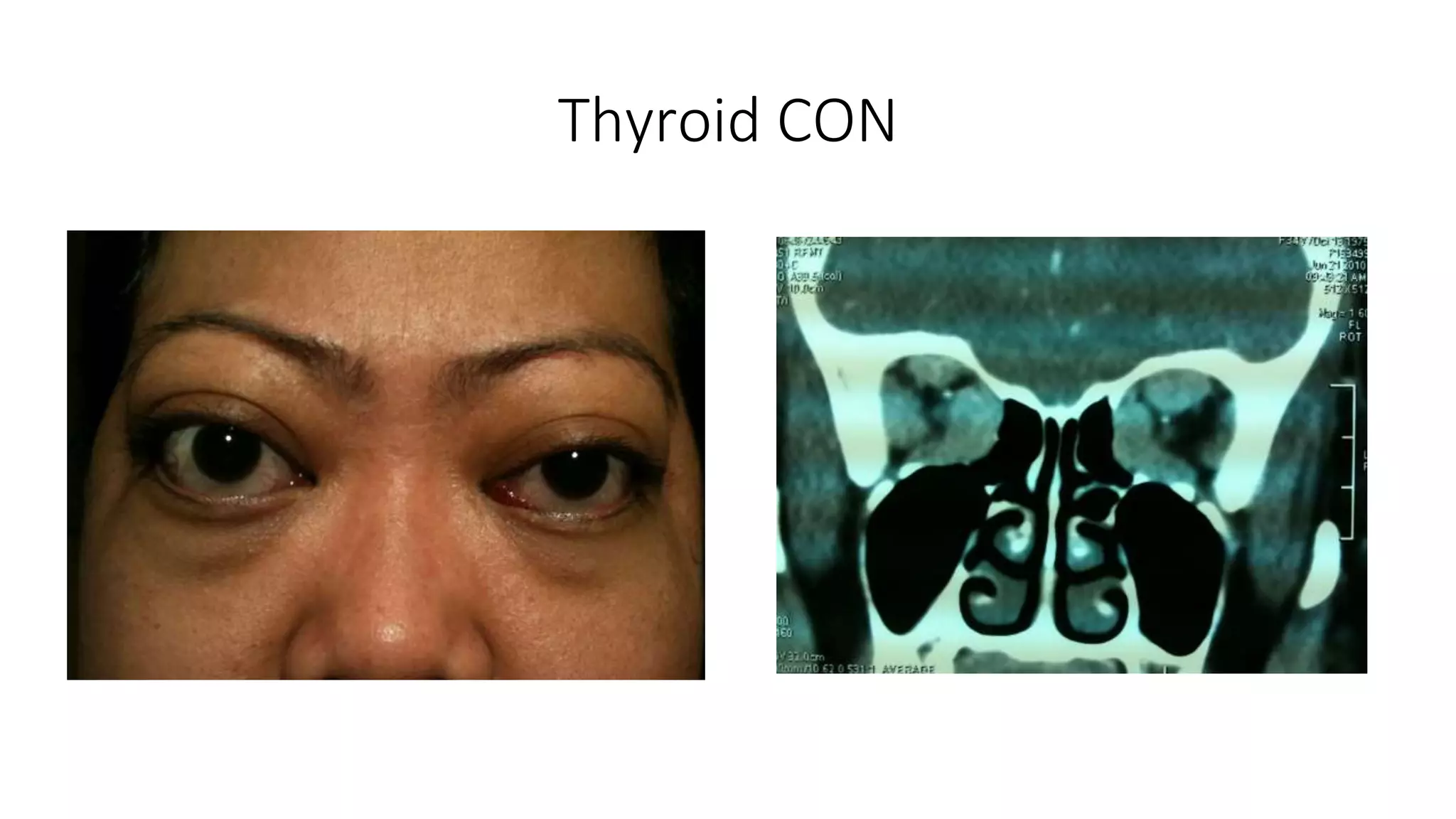 Thyroid eye disease ( Graves Ophthalmopathy ) | PPTX
