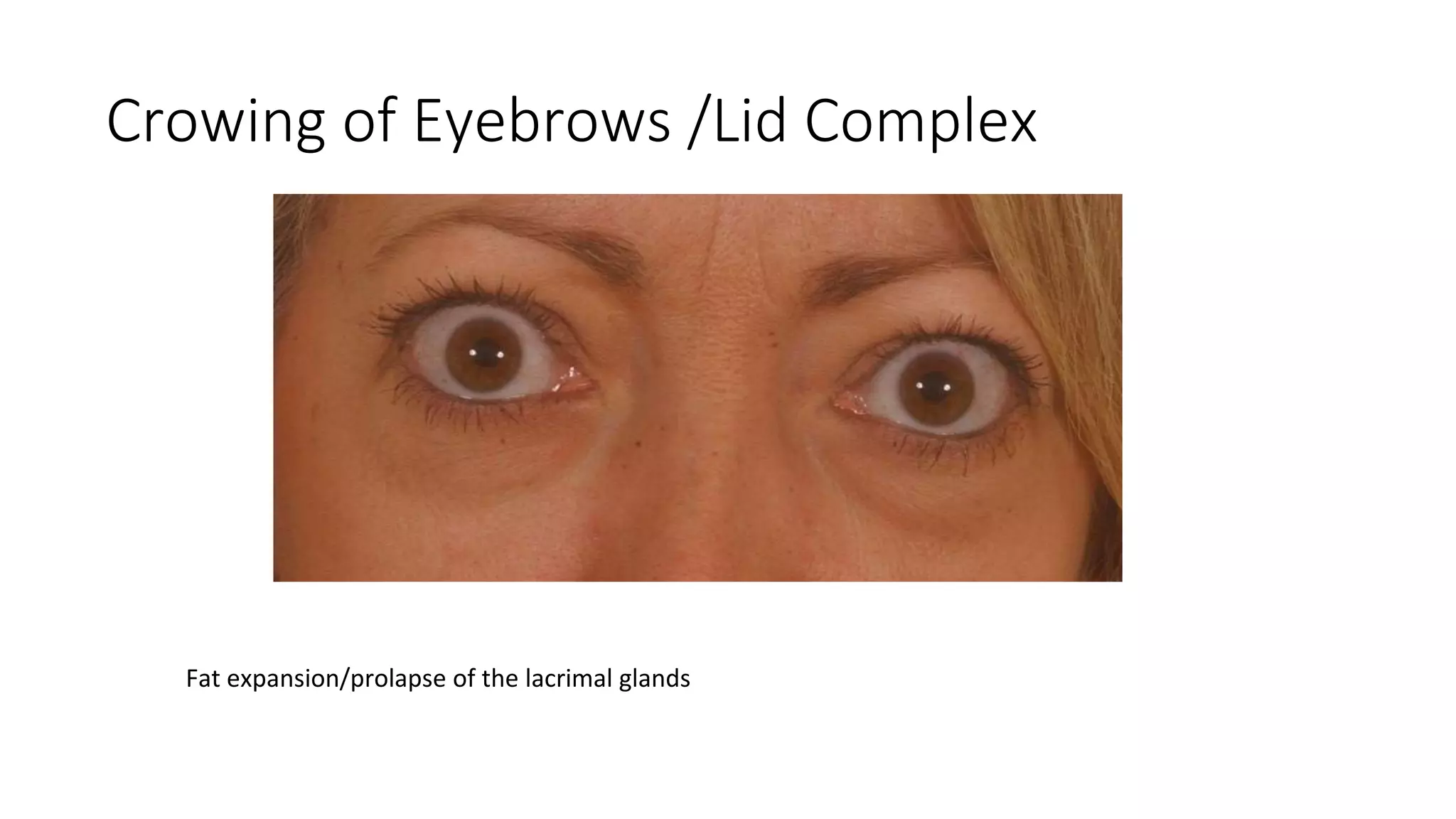 Thyroid eye disease ( Graves Ophthalmopathy ) | PPTX