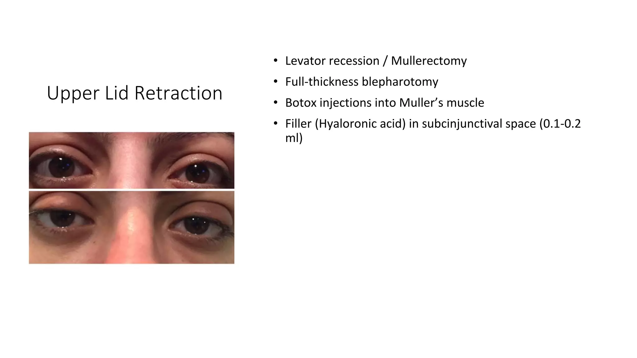 Thyroid eye disease ( Graves Ophthalmopathy ) | PPTX