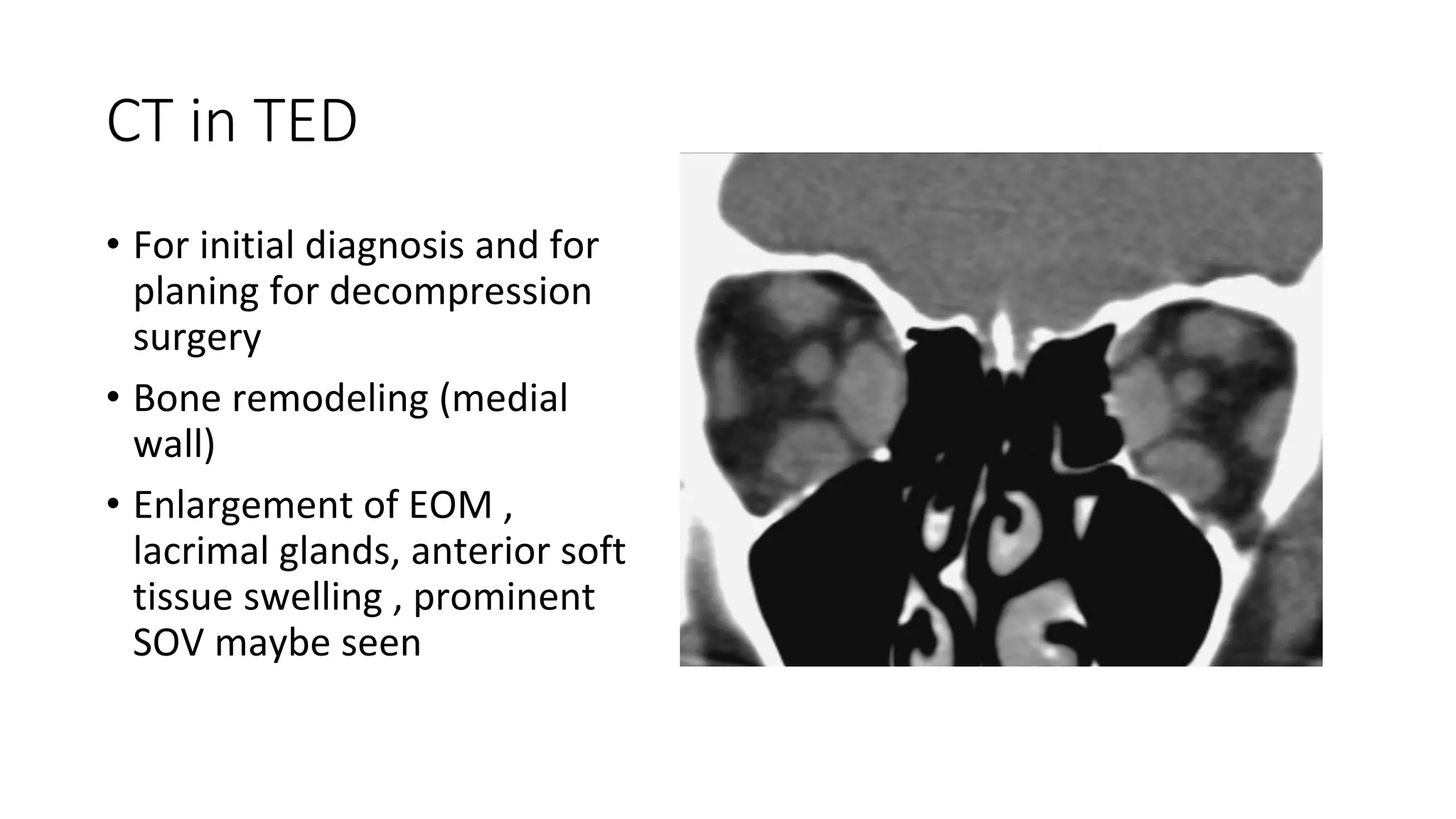 Thyroid eye disease ( Graves Ophthalmopathy ) | PPTX