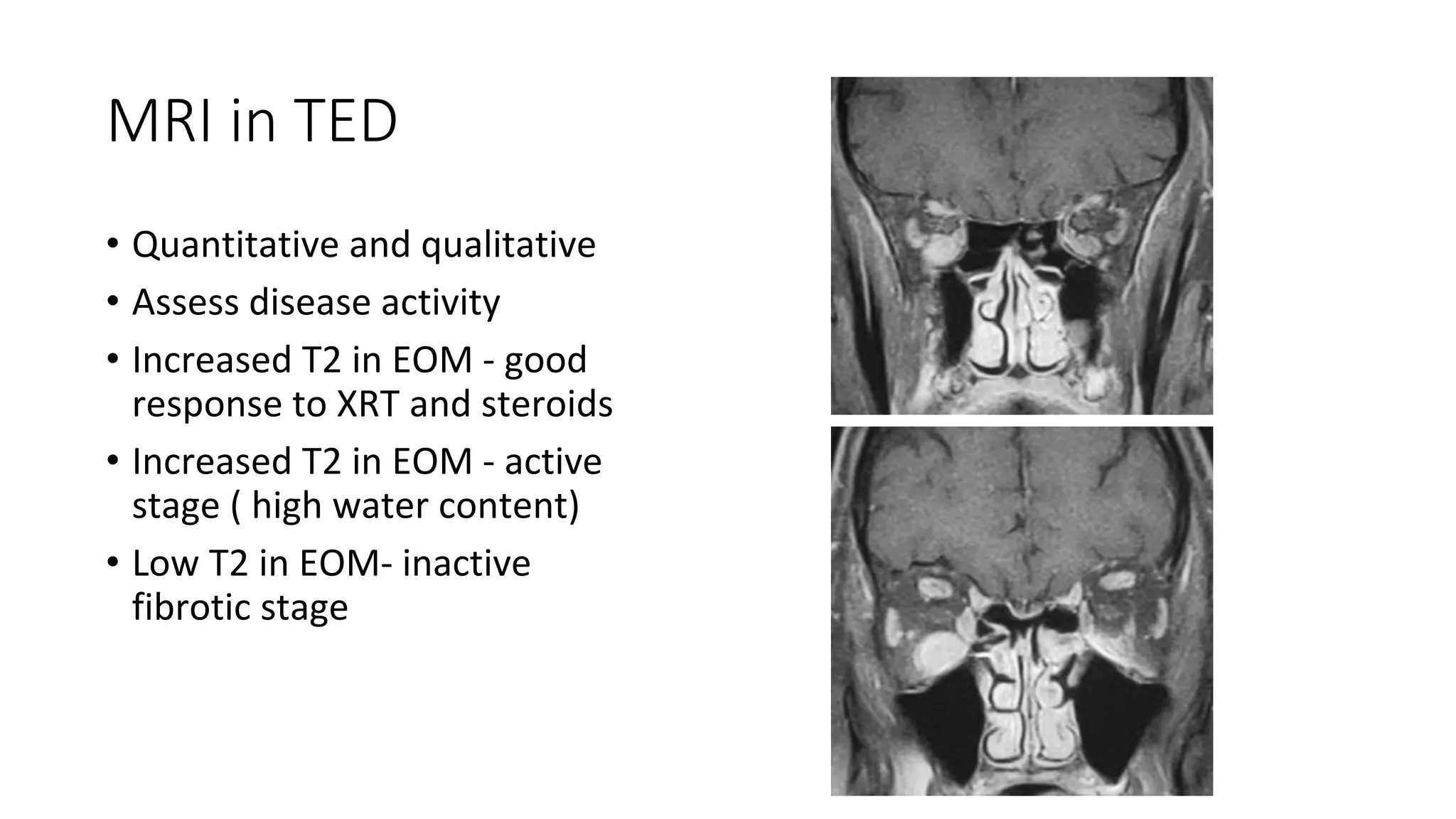 Thyroid eye disease ( Graves Ophthalmopathy ) | PPTX