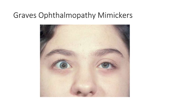 Thyroid eye disease ( Graves Ophthalmopathy ) | PPTX