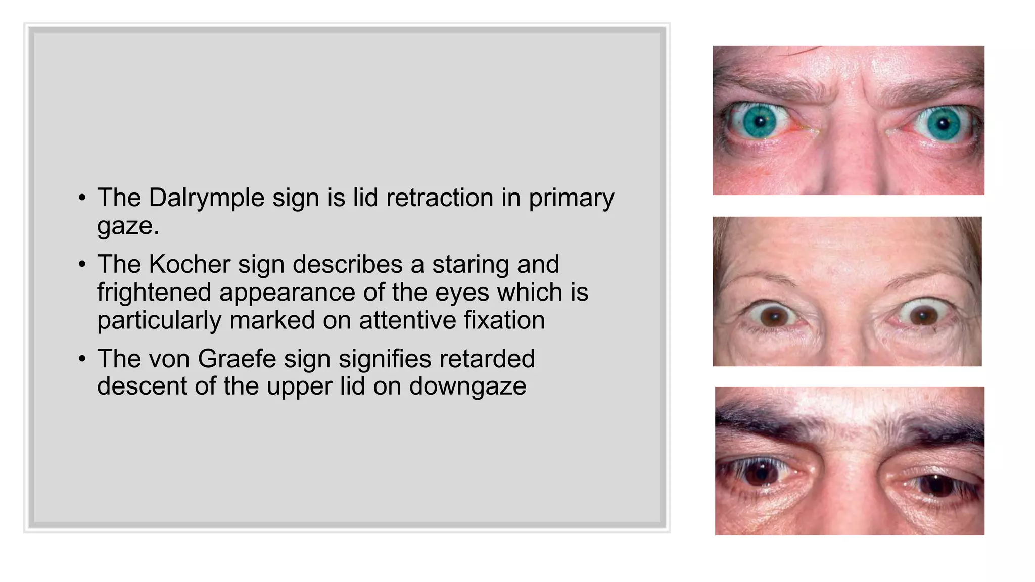 Thyroid eye disease | PPTX