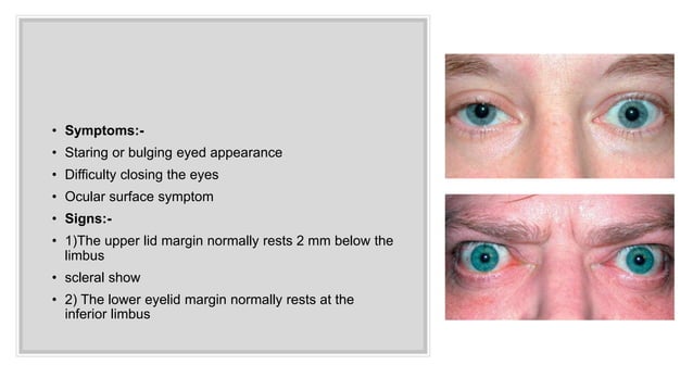 Thyroid eye disease | PPTX | Thyroid Disorders | Endocrine and ...