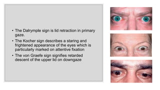 Thyroid eye disease | PPTX