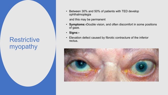 Thyroid eye disease | PPTX | Thyroid Disorders | Endocrine and ...