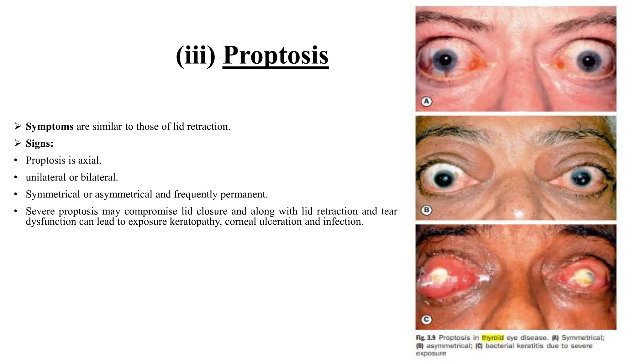 Thyroid eye disease.pptx