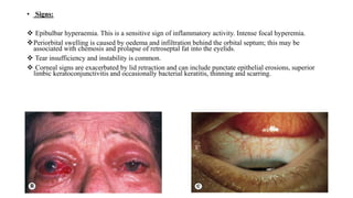 Thyroid eye disease.pptx