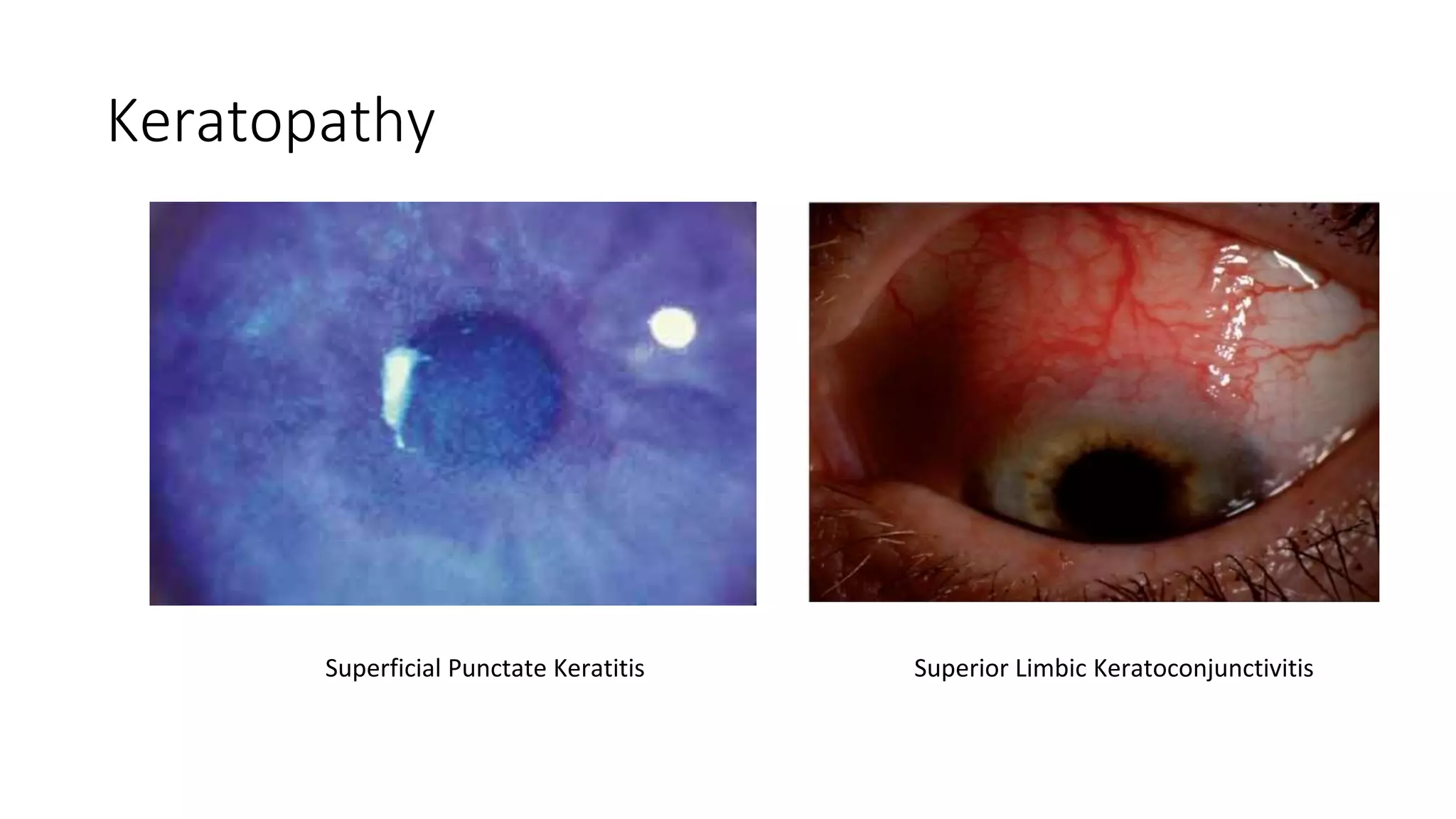 Graves Orbitopathy | PPTX