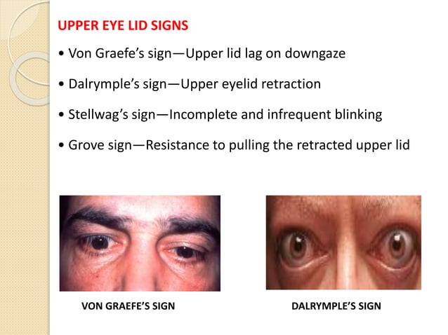 Thyroid eye disease | PPT