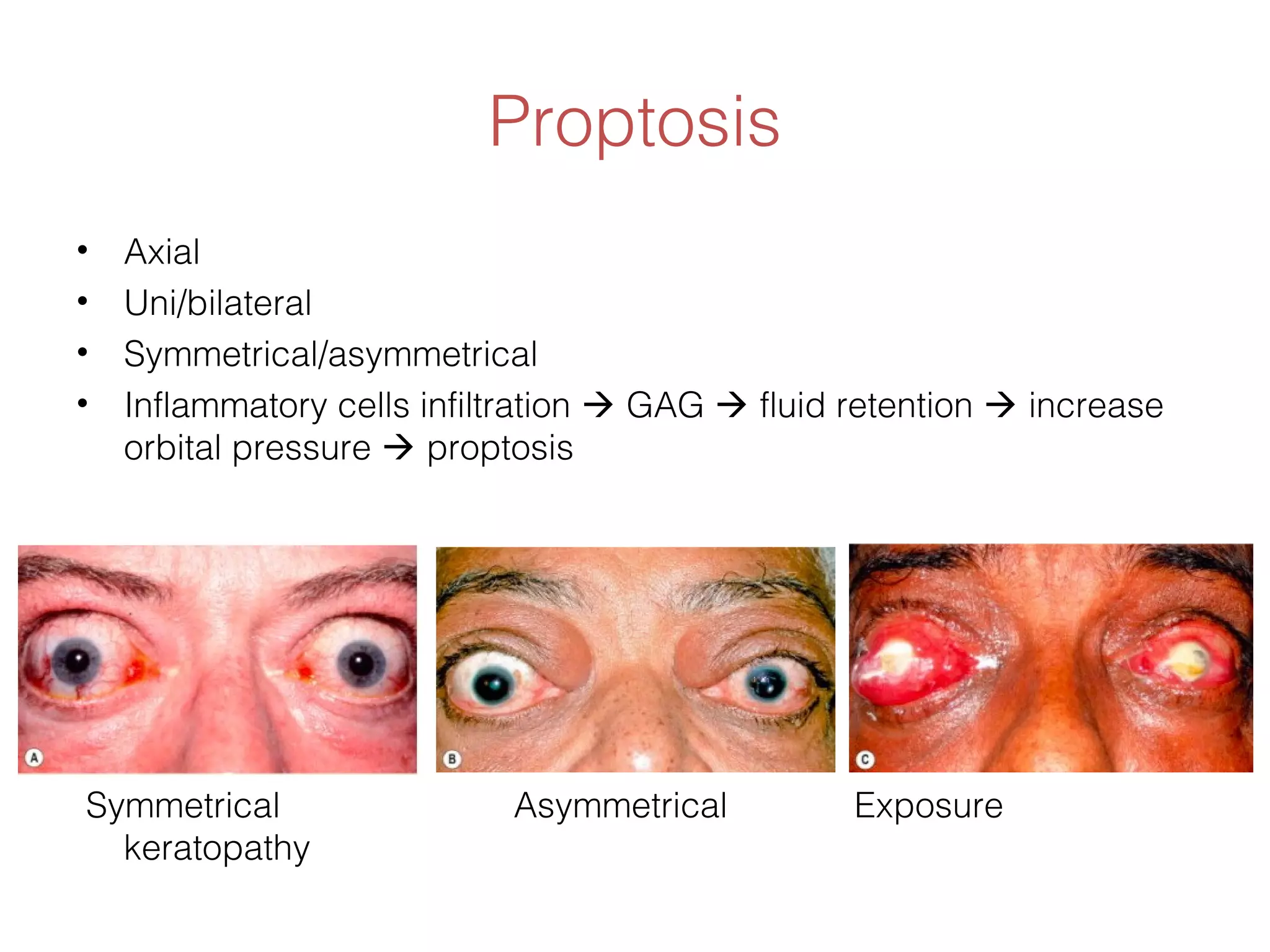 Thyroid eye disease presentation | PPT