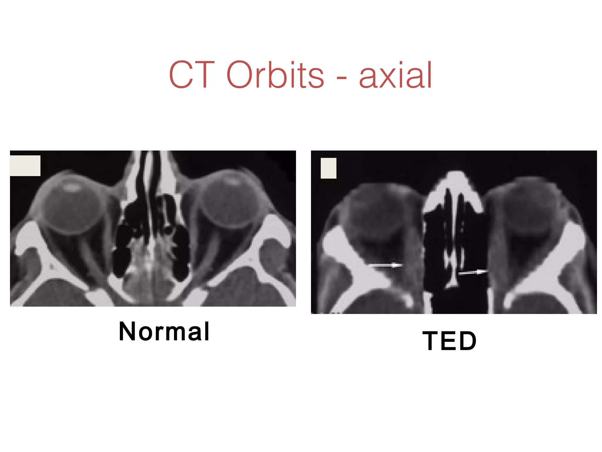 Thyroid eye disease presentation | PPT