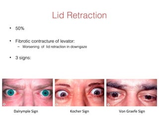 Thyroid eye disease presentation | PPT