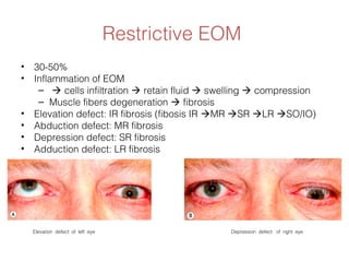 Thyroid eye disease presentation | PPT