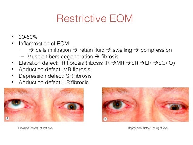 Thyroid eye disease presentation