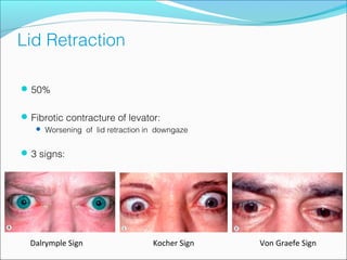 Thyroid eye disease presentation | PPT