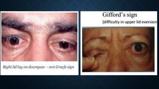 THYROID EYE DISEASE presentation( Thyroid orbitopathy).pptx