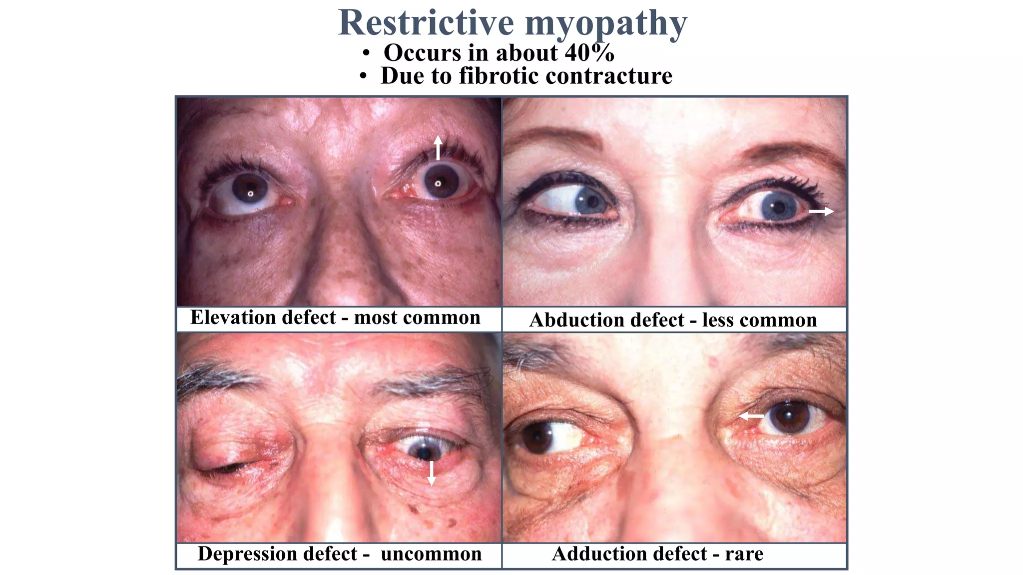 Thyroid eye diseases | PPTX