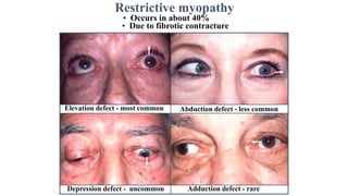 Thyroid eye diseases | PPTX | Thyroid Disorders | Endocrine and ...