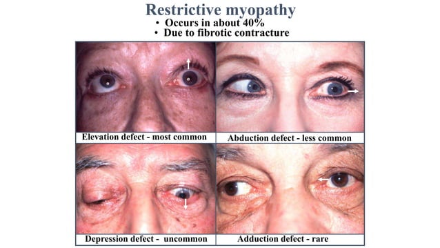 Thyroid eye diseases | PPTX | Thyroid Disorders | Endocrine and ...