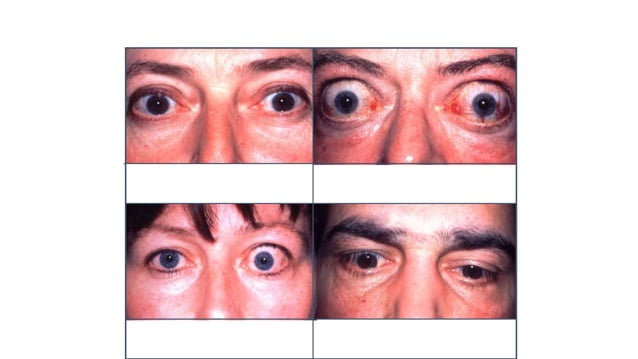 Thyroid eye diseases | PPTX | Thyroid Disorders | Endocrine and ...