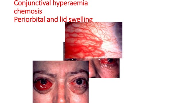 Thyroid eye diseases | PPTX | Thyroid Disorders | Endocrine and ...