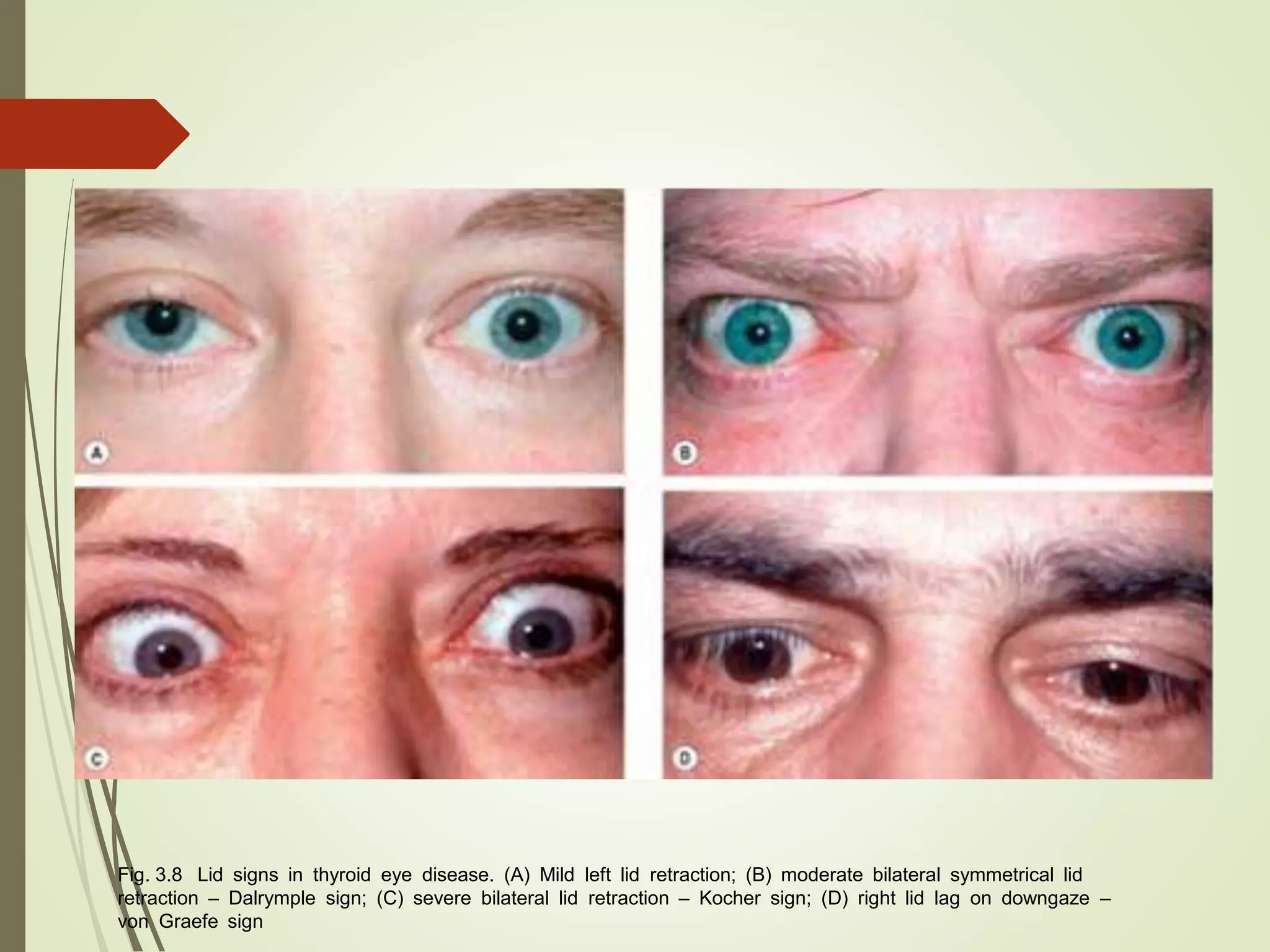 Thyroid eye diseases | PPTX