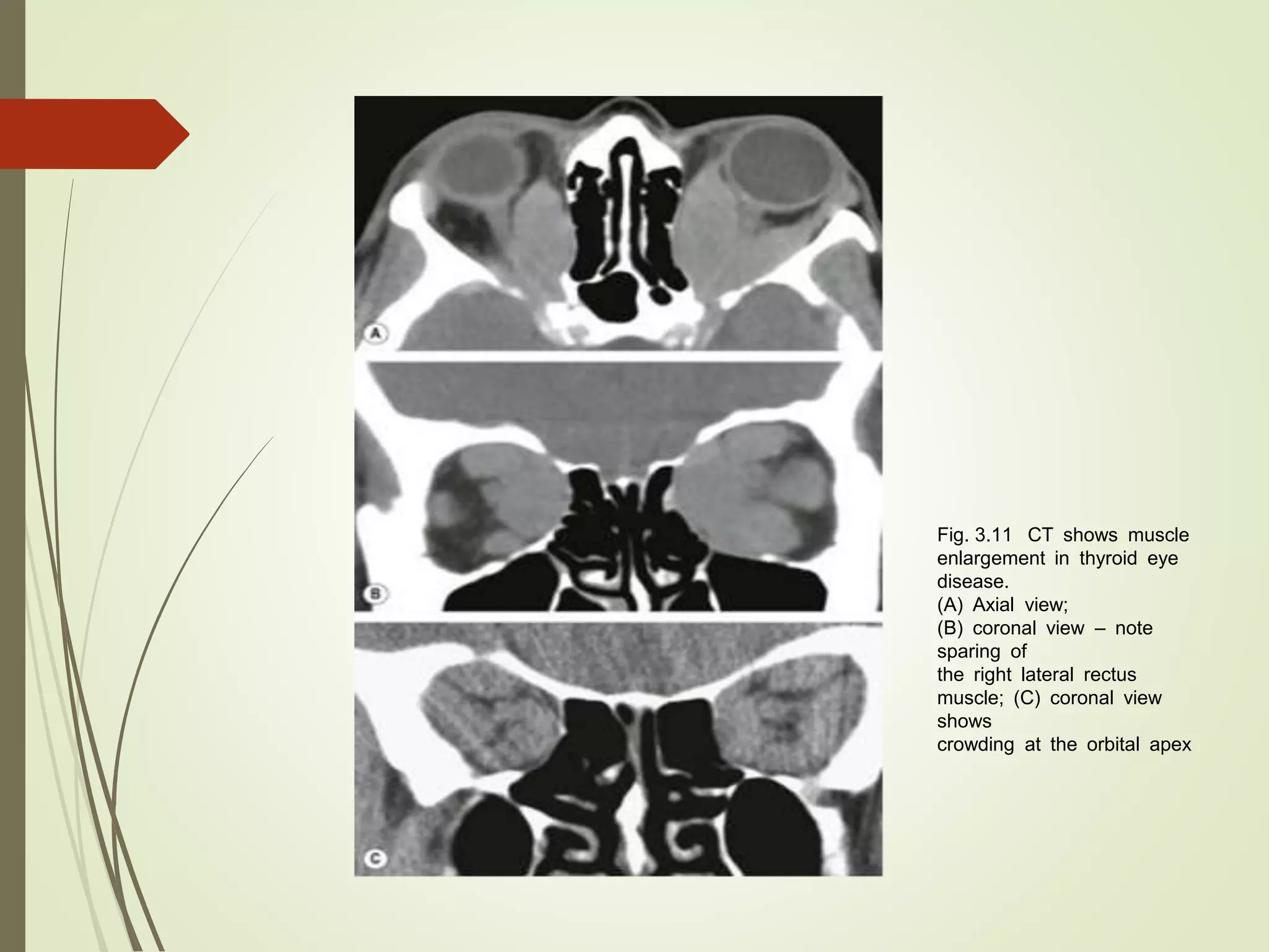Thyroid eye diseases | PPTX