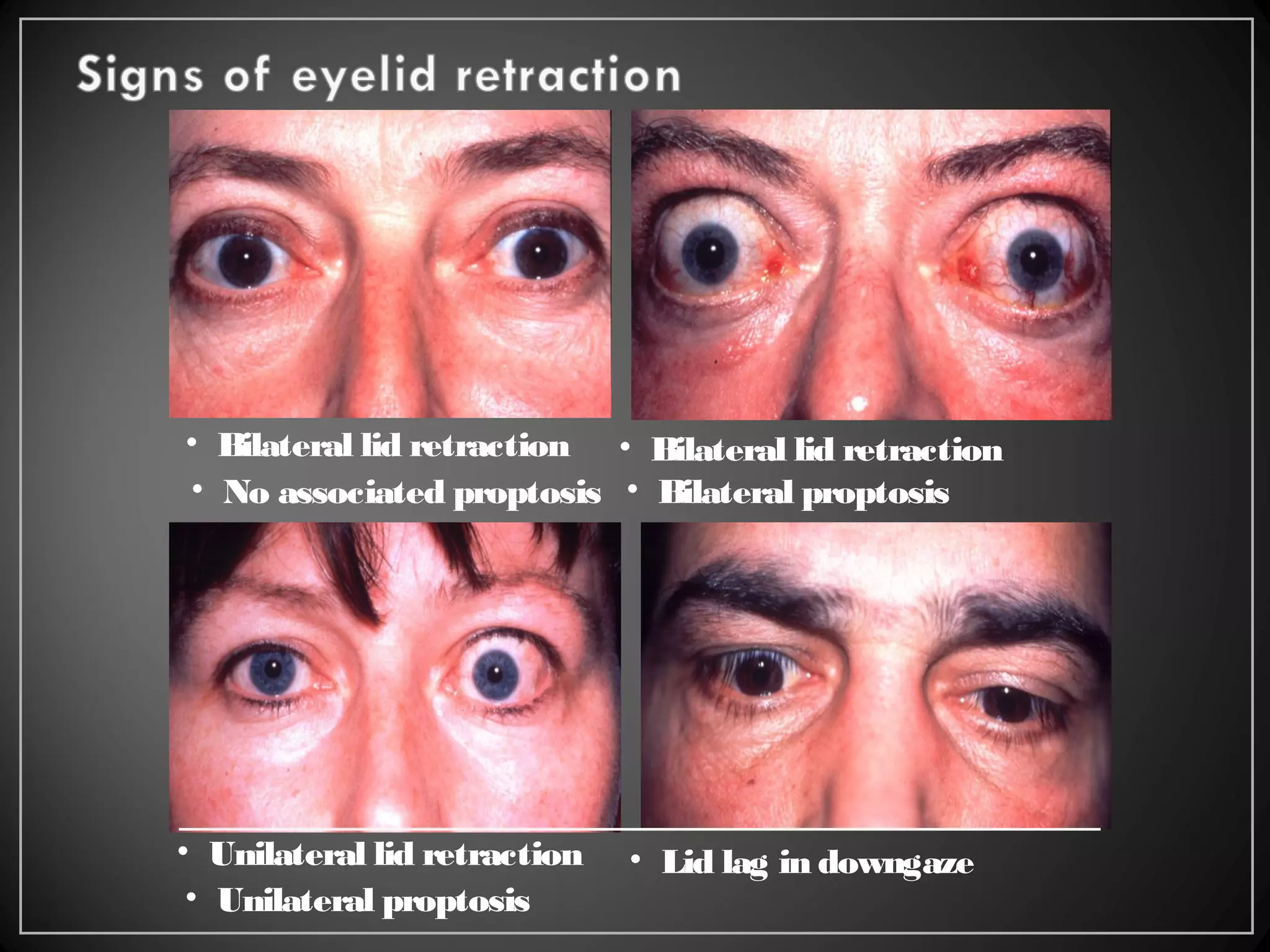 Thyroid eye diseases | PPT