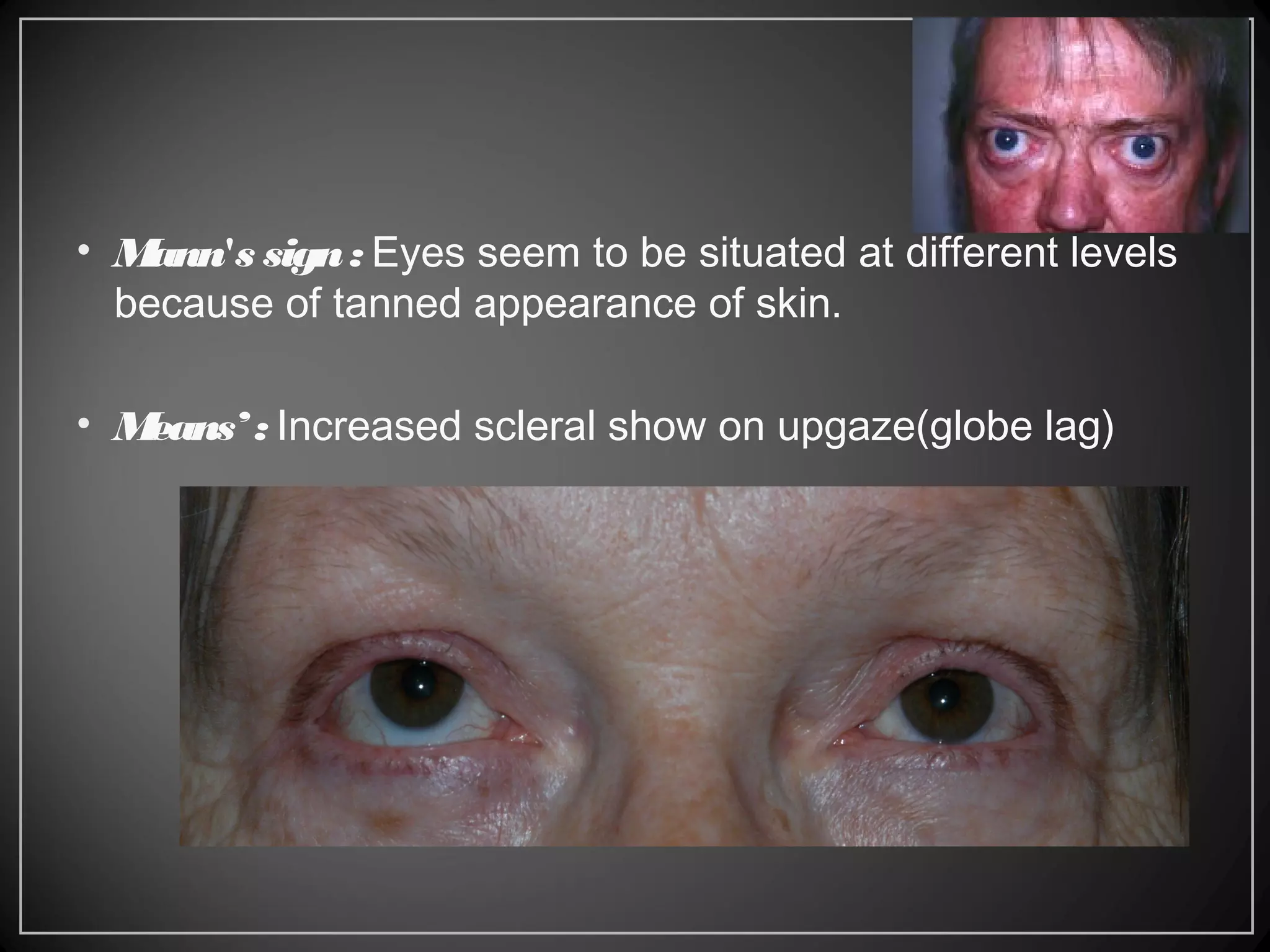 Thyroid eye diseases | PPT