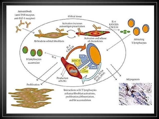 Thyroid eye diseases | PPT | Thyroid Disorders | Endocrine and ...