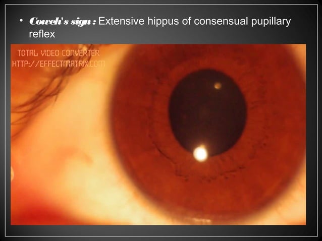 Thyroid eye diseases | PPT | Thyroid Disorders | Endocrine and ...